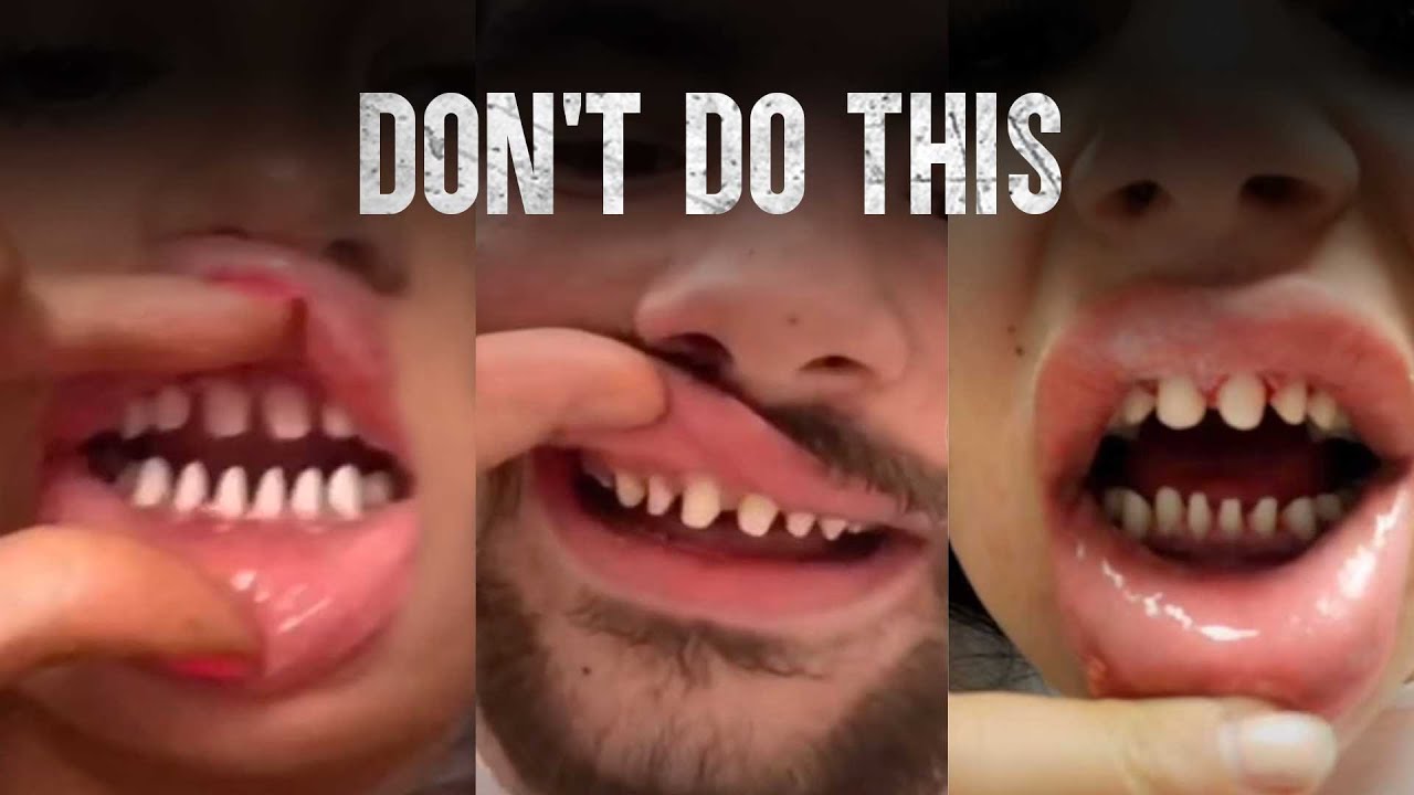 How to protect yourself from risks of the TikTok veneer trend