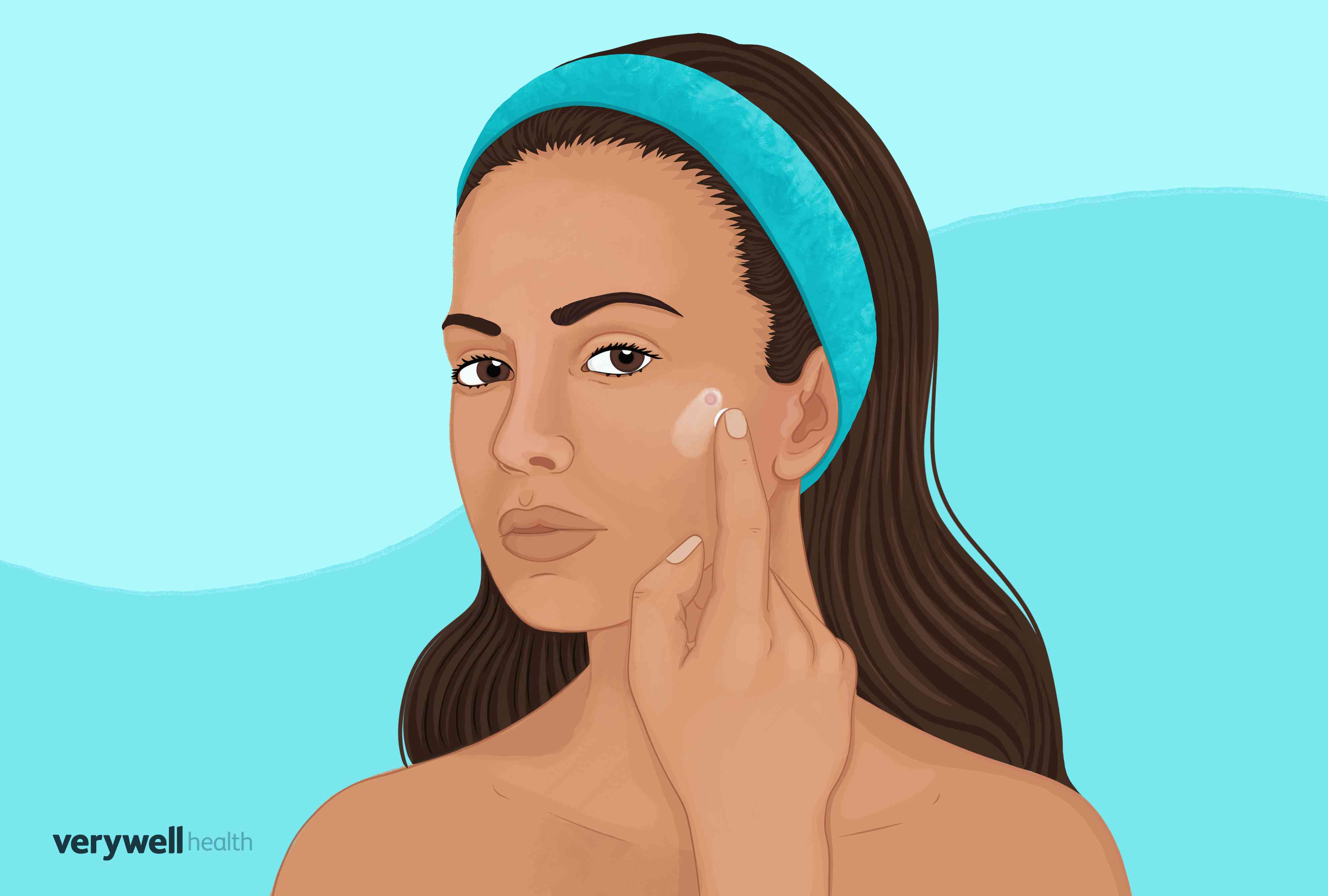 How to Heal a Popped Pimple Fast