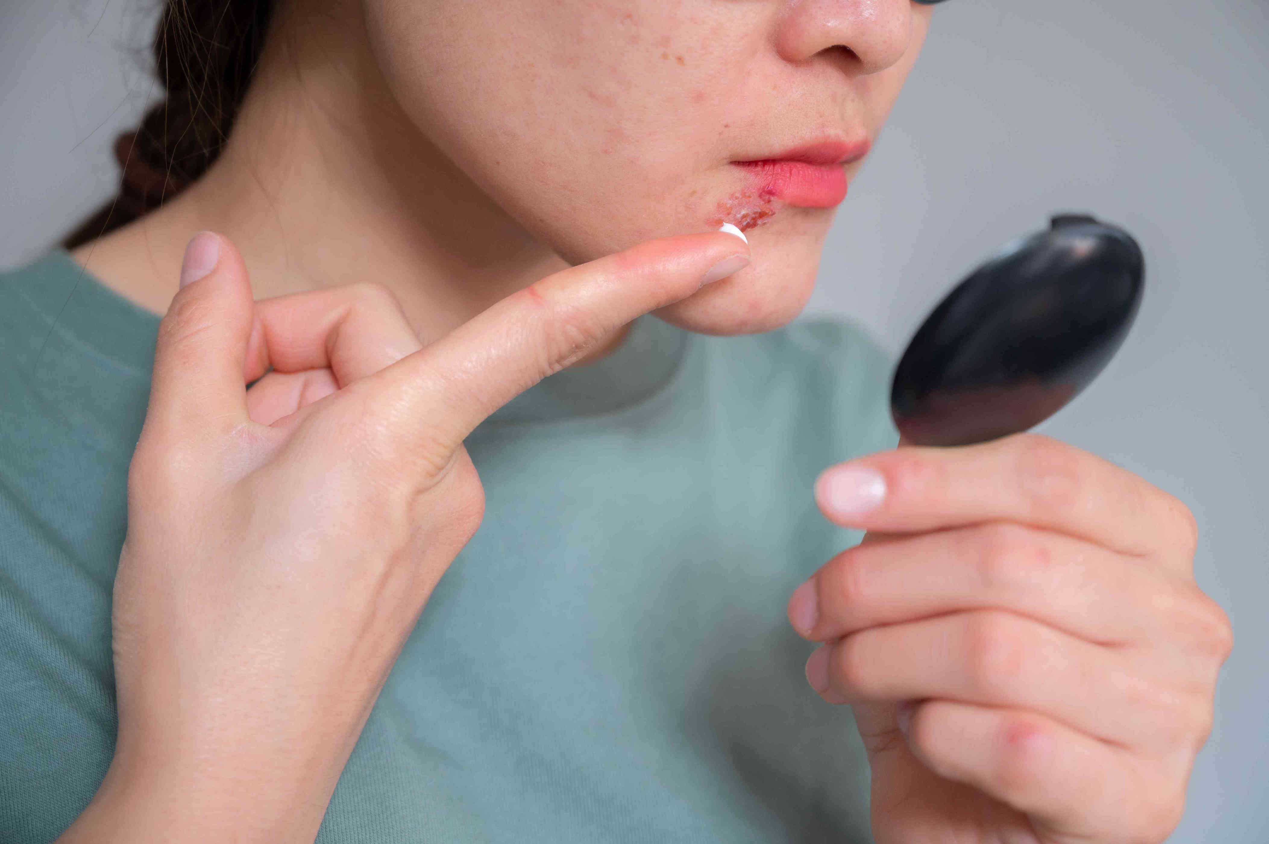 How To Get Rid of Lip Pimples: Causes and Prevention Tips