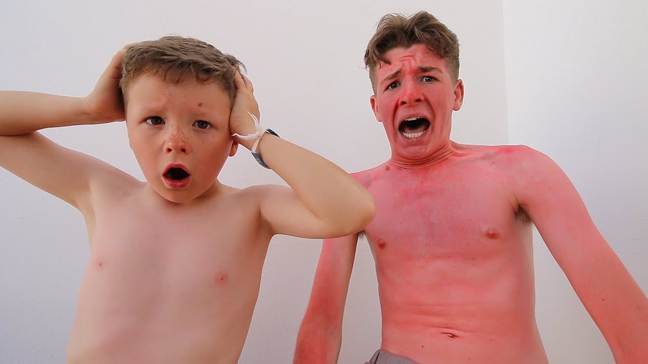 The Sunburn Prank on My Little Brother