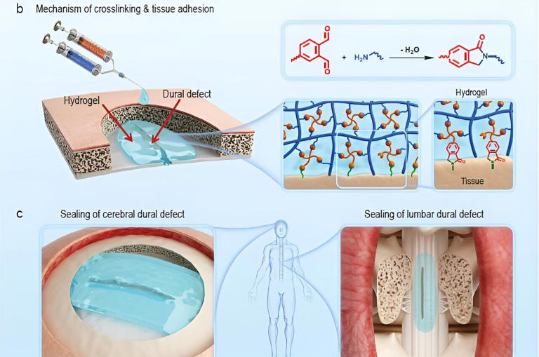 Researchers Develop Low Swelling Hydrogel Sealant With Benefits For