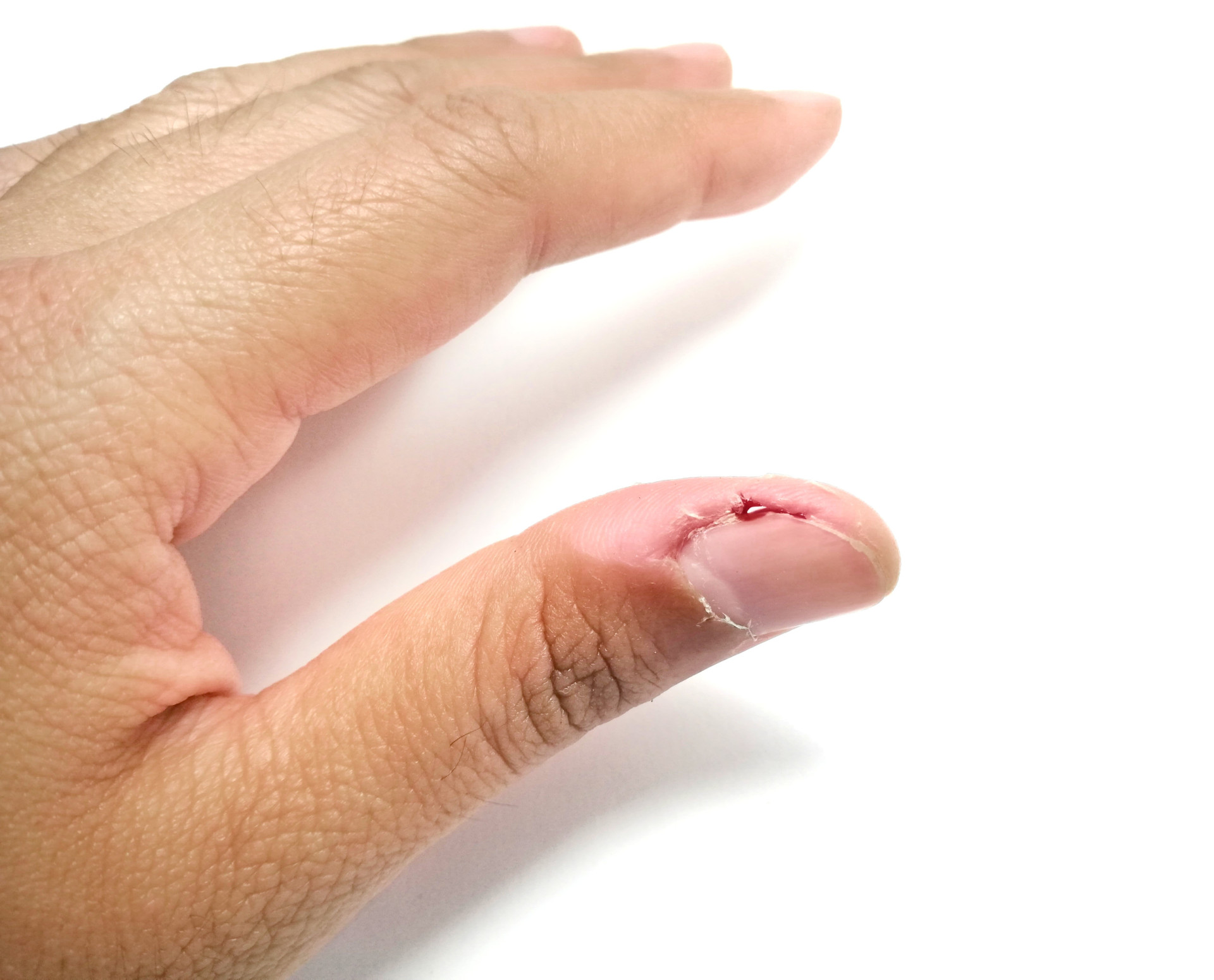 How serious is skin picking disorder?