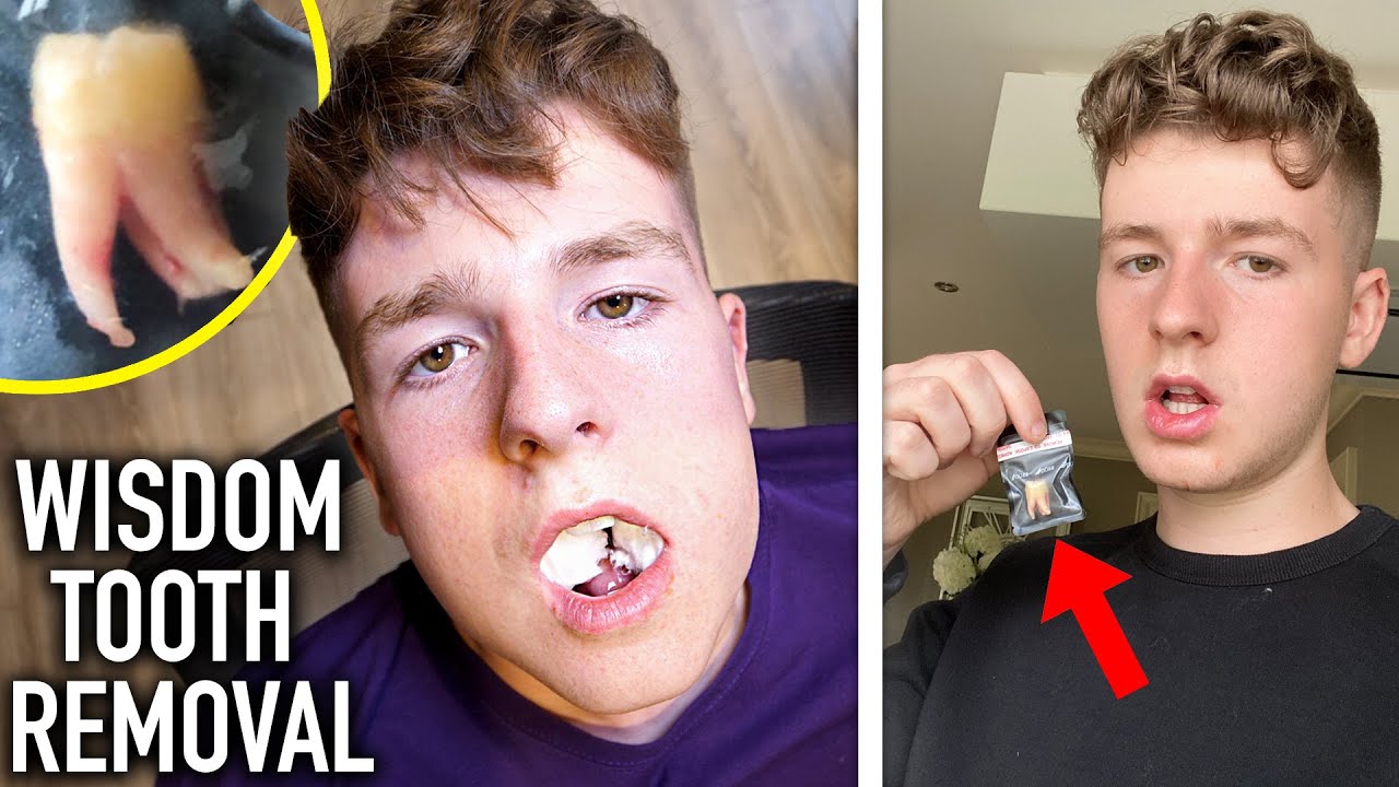 Getting my wisdom teeth removed