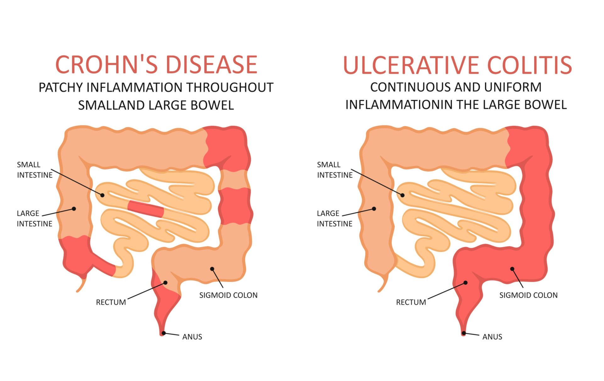 Facts you never knew about inflammatory bowel disease