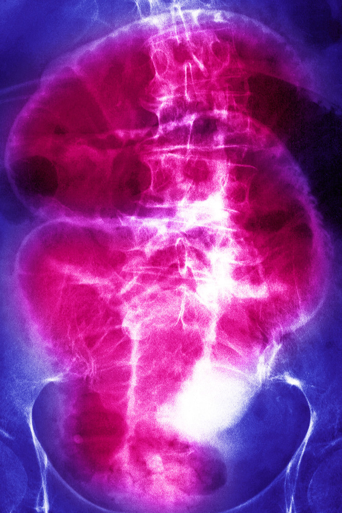 Inflammatory bowel disease: symptoms, causes, and everything else you ...