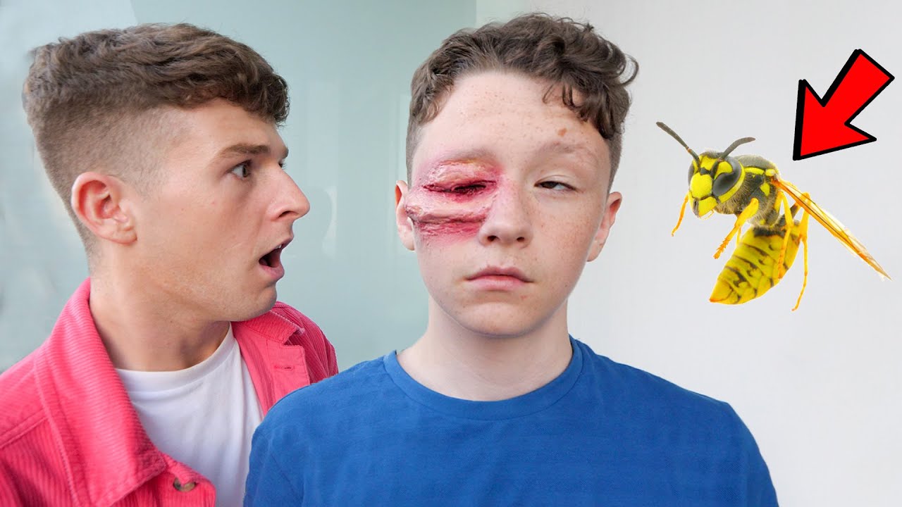 Bee Sting Allergic Reaction