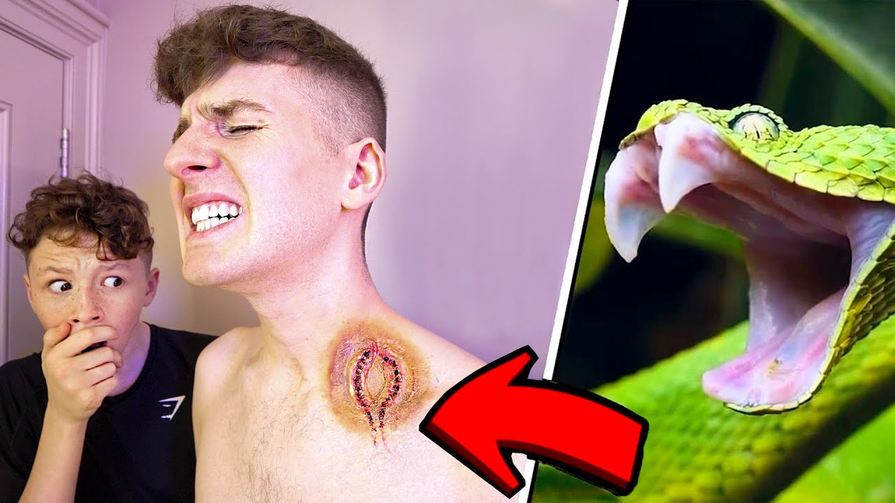 I Was Attacked by a Snake