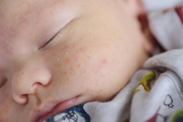 Types of Baby Rash & How to Treat & Prevent Them: Your New Mom Guide