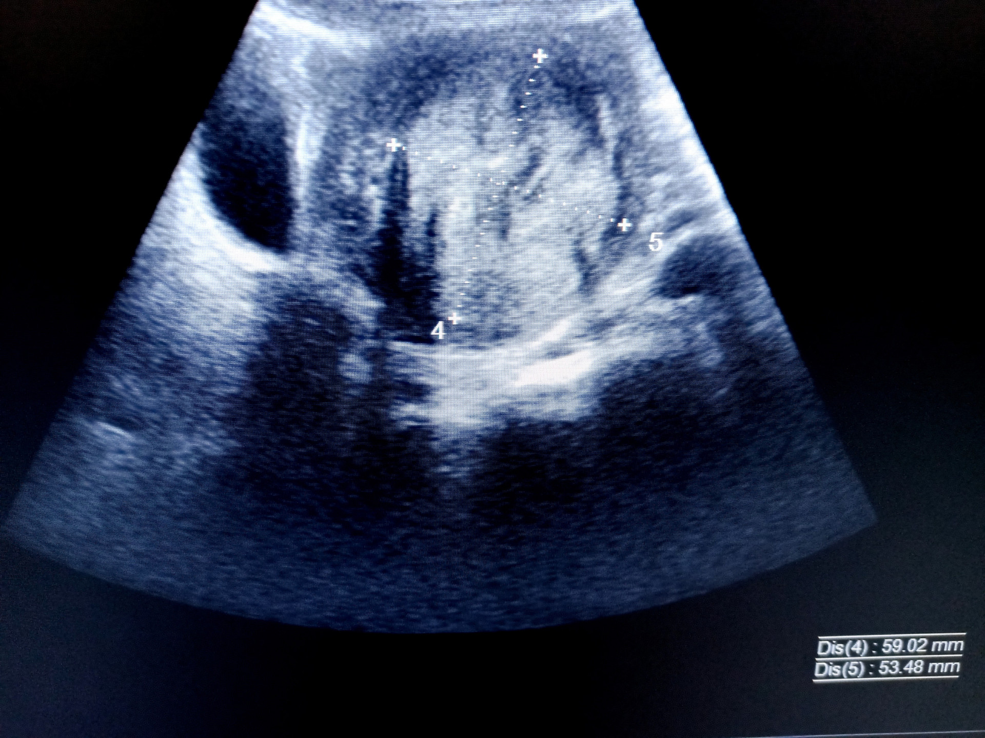 What are uterine fibroids, and how are they treated?