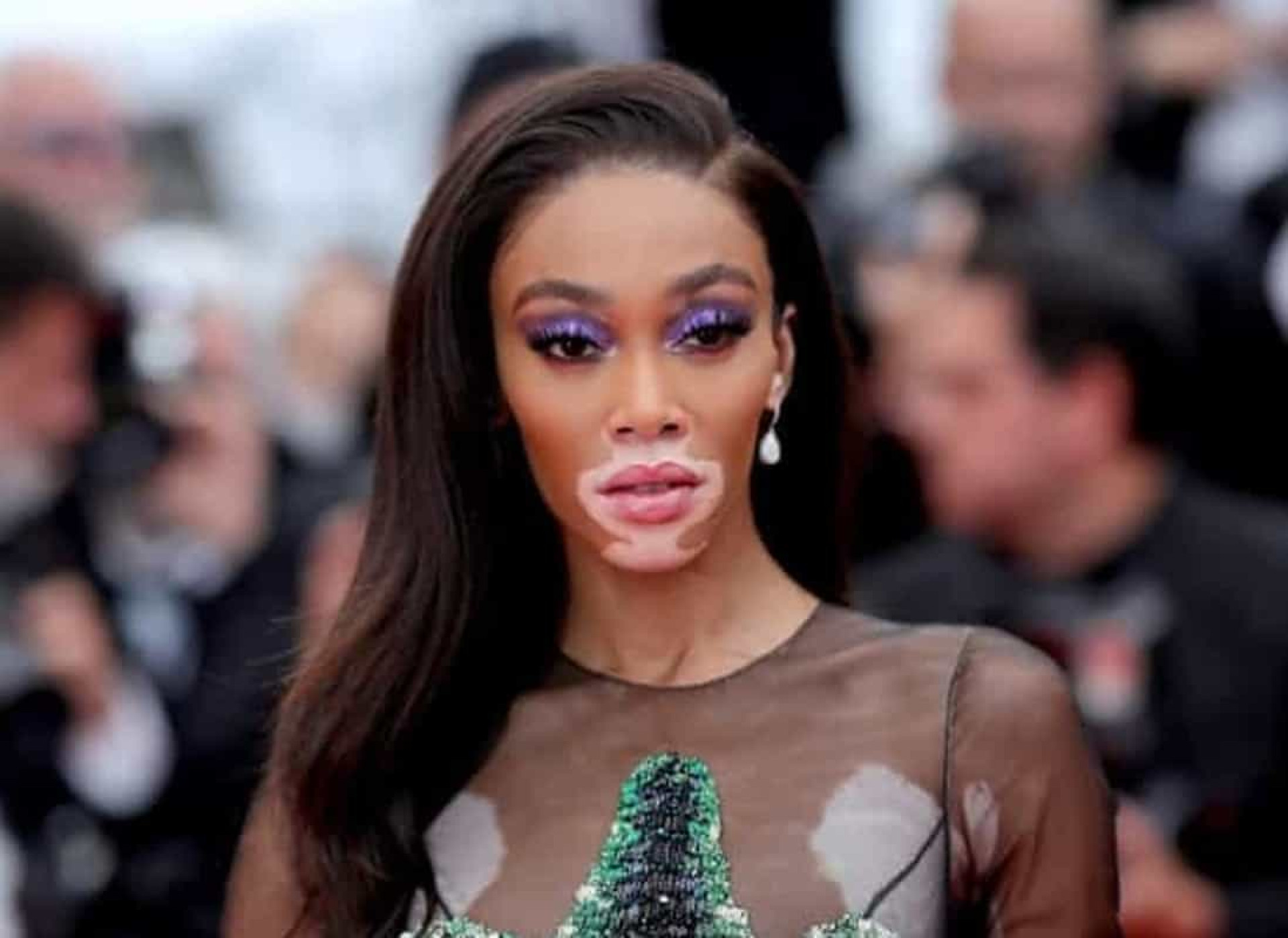 Celebrities Who Suffer From Skin Conditions