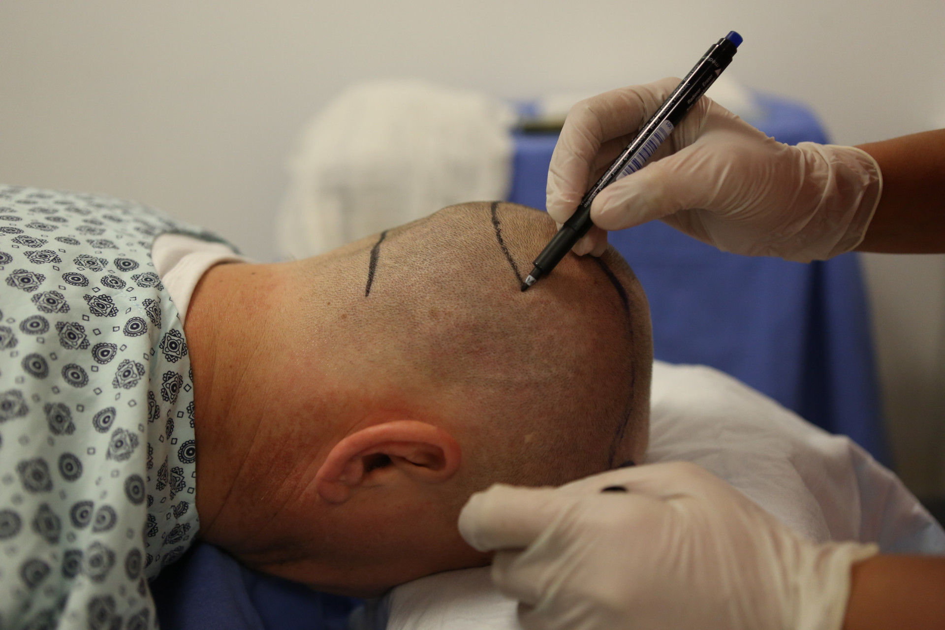 Which countries have the most bald men?