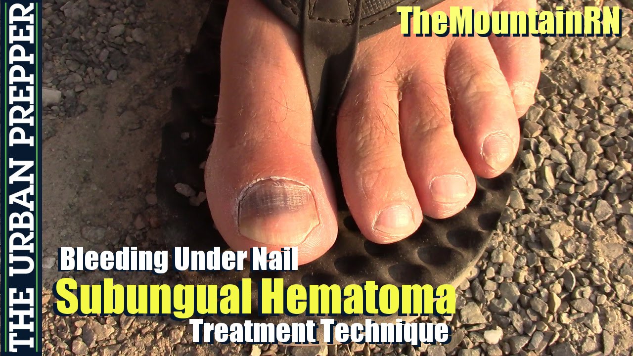 Blood under nail treatment method with TheMountainRN
