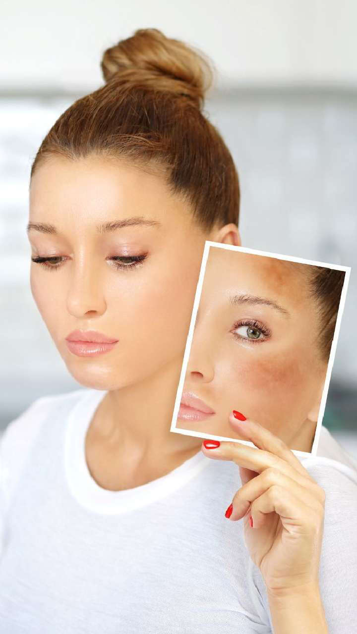 4 Best Expert-Approved Remedies To Treat Hyperpigmentation At Home 4 Best Expert-Approved Remedies To Treat Hyperpigmentation At Home