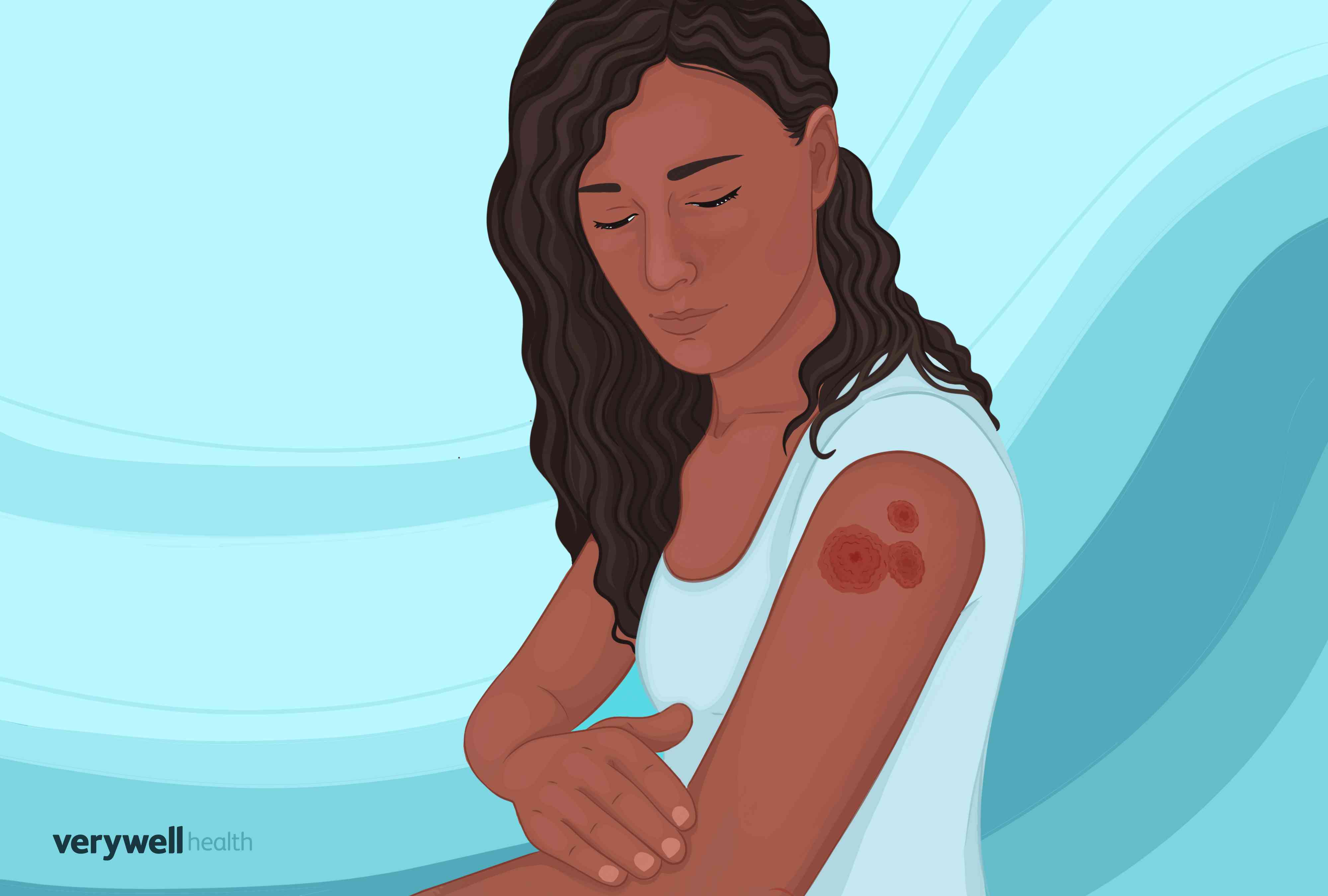 9 Circular Rashes That Aren't Ringworm