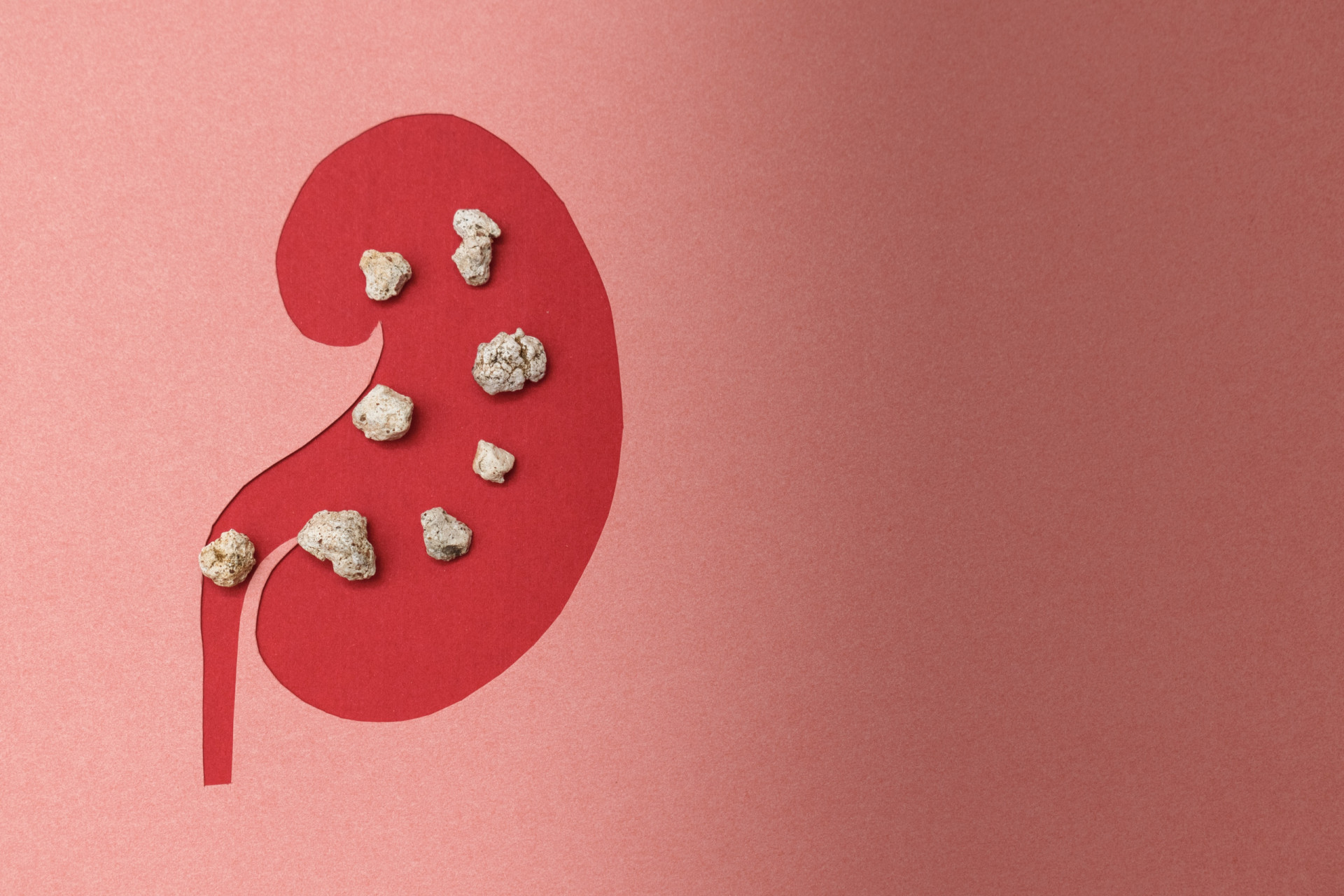 Everything you need to know about kidney stones