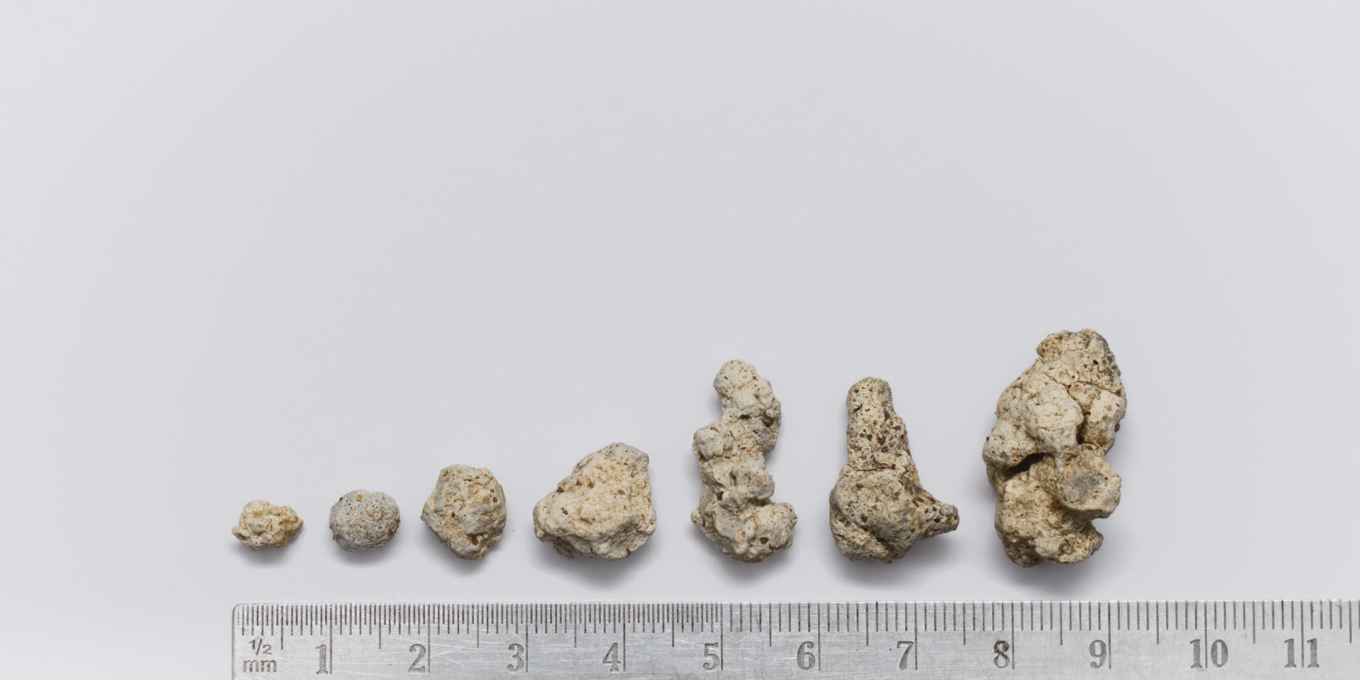 Everything you need to know about kidney stones