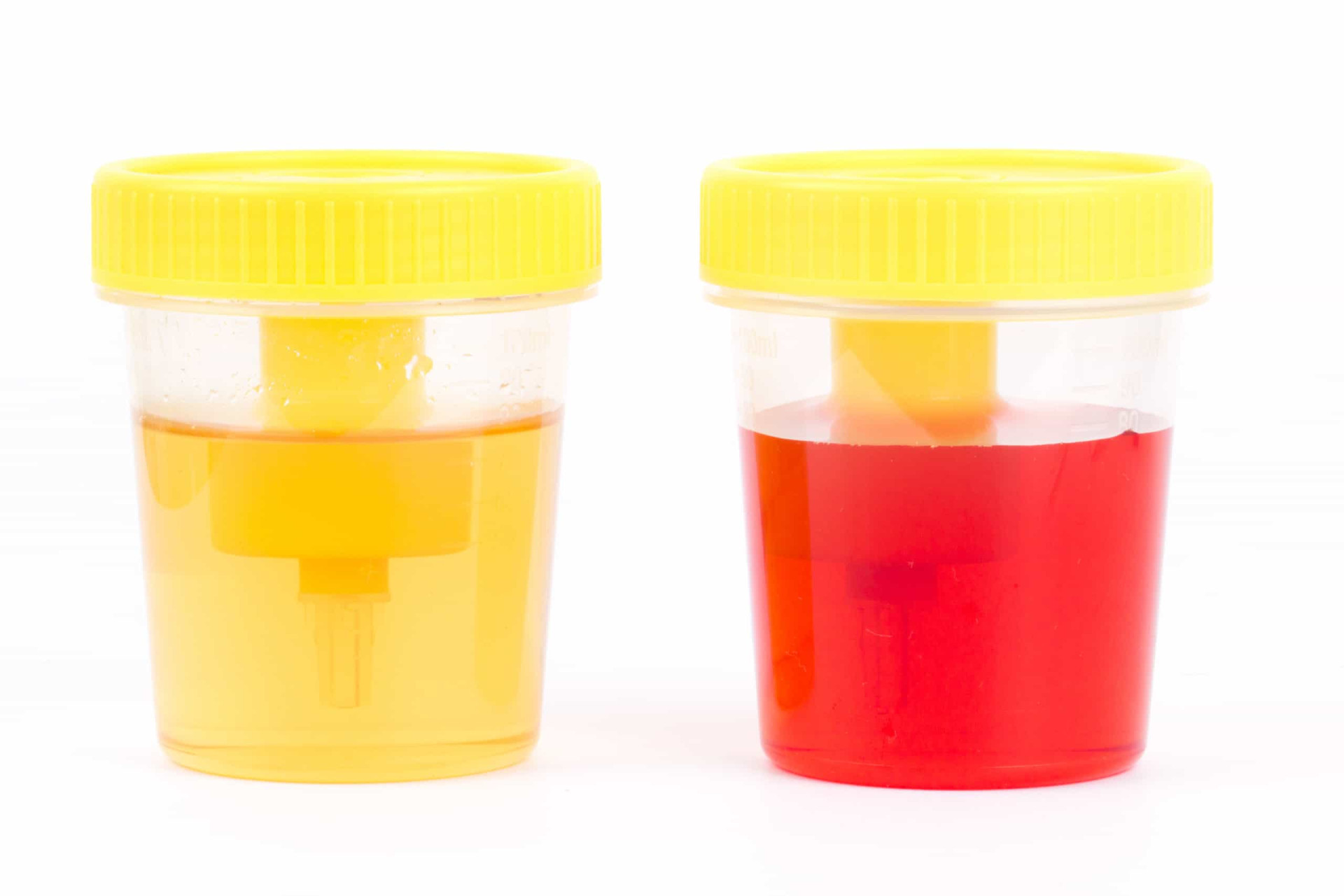 Bladder cancer: The signs, symptoms, and treatments