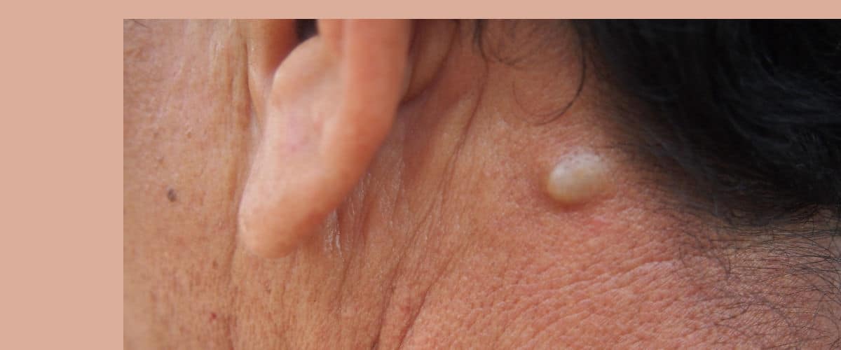 Quiste Sebáceo: Causas, Tratamiento y Cuidados Necesarios