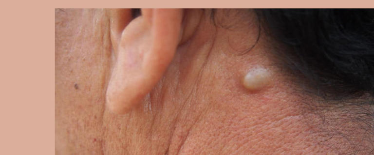 Quiste Sebáceo: Causas, Tratamiento y Cuidados Necesarios