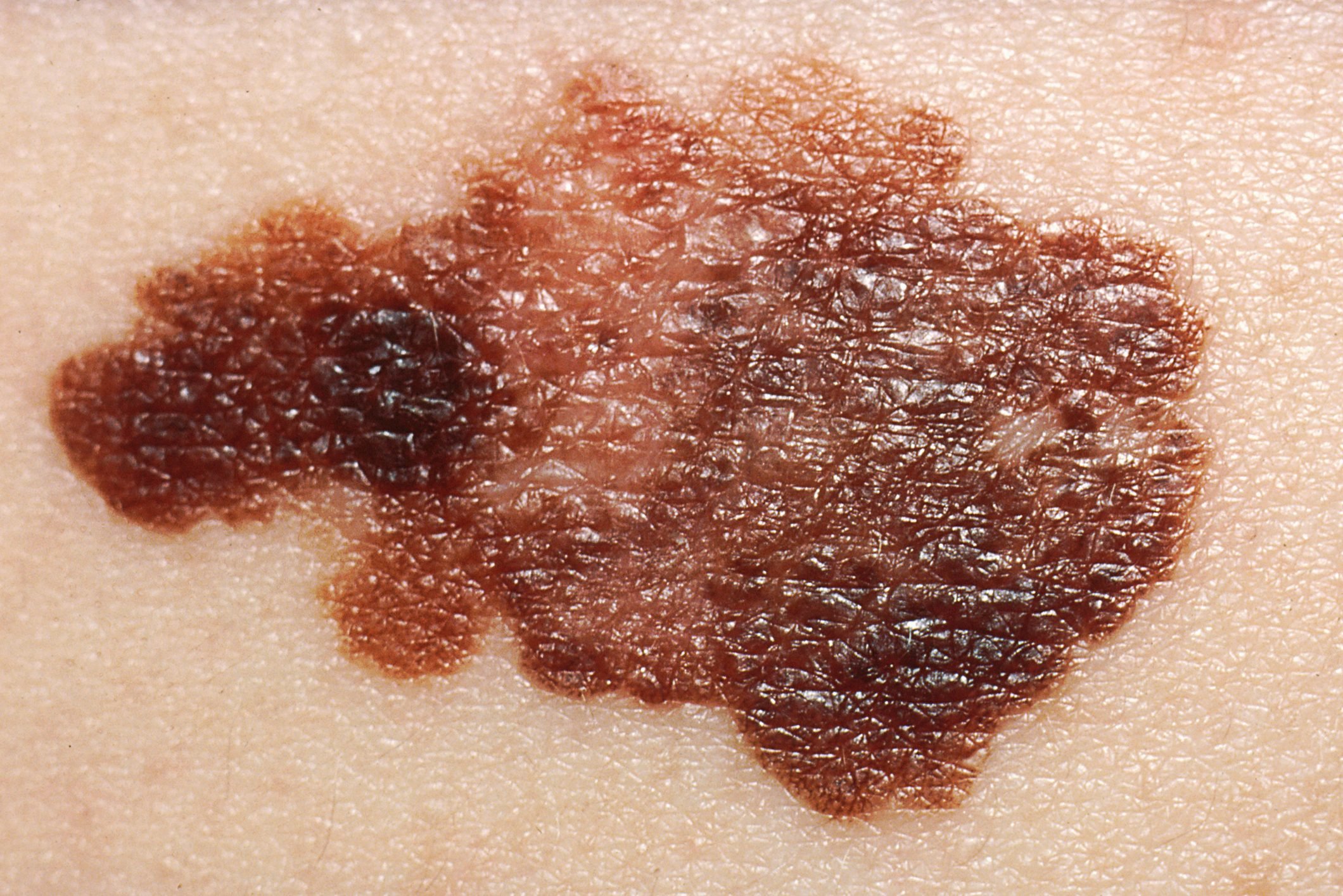 New Study: Low Levels of This Vitamin May Increase Melanoma Skin Cancer ...