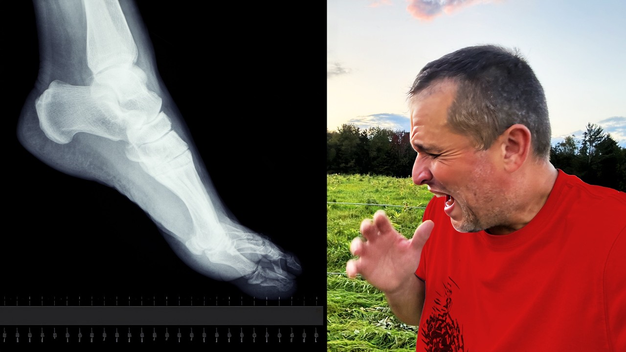 What happened when I broke my toe farming