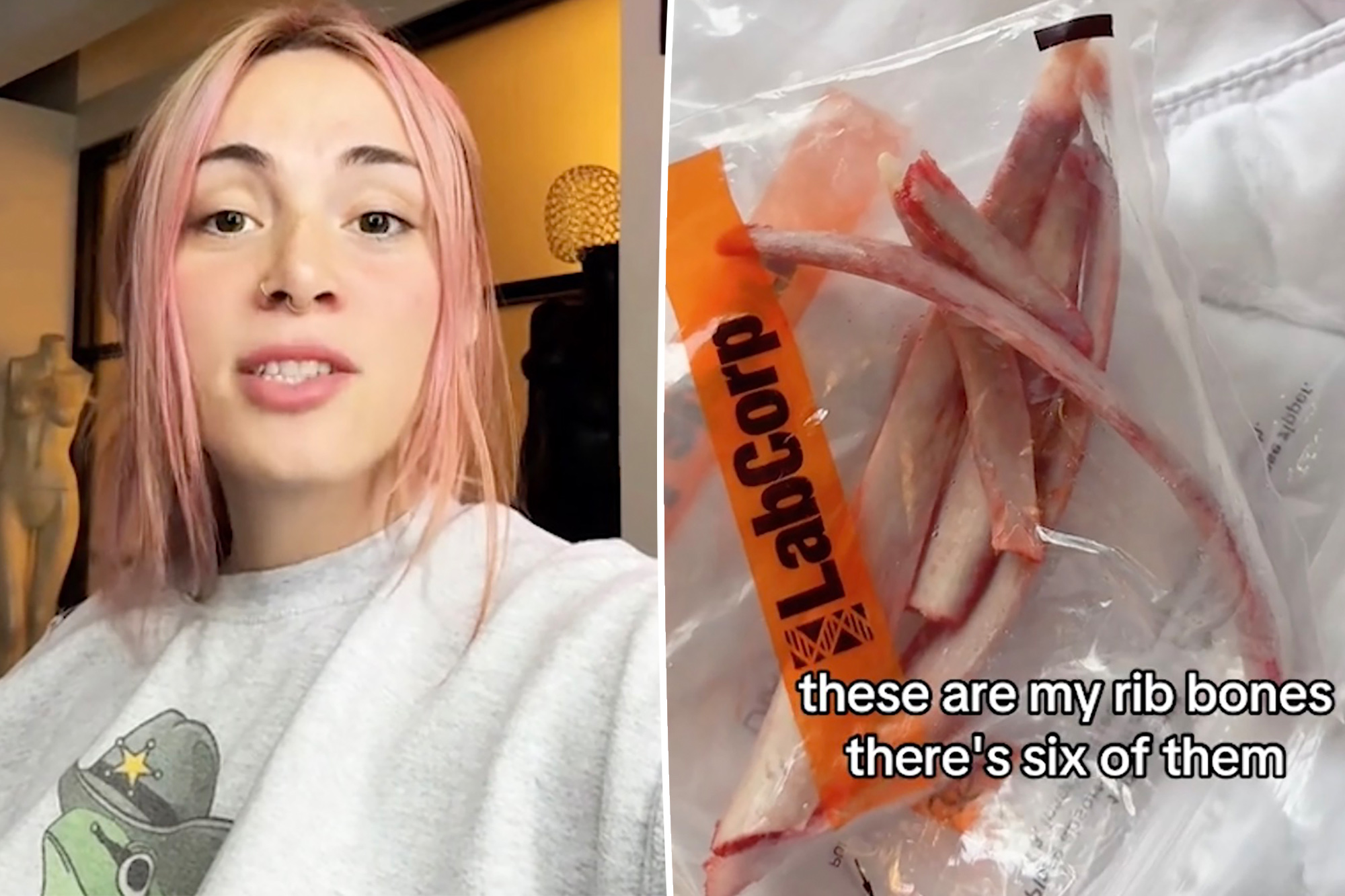 I spent $17,000 having my ribs removed for a smaller waist — now I’m ...