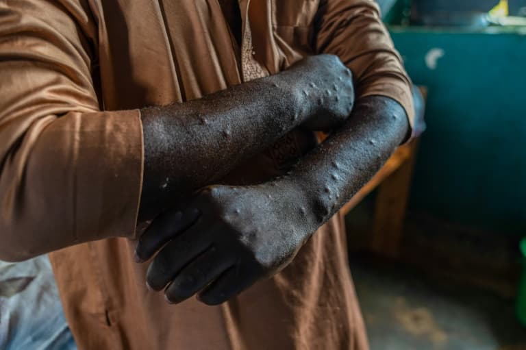 Mpox: un premier cas du "clade 1b" confirmé au Sierra Leone, le patient ...