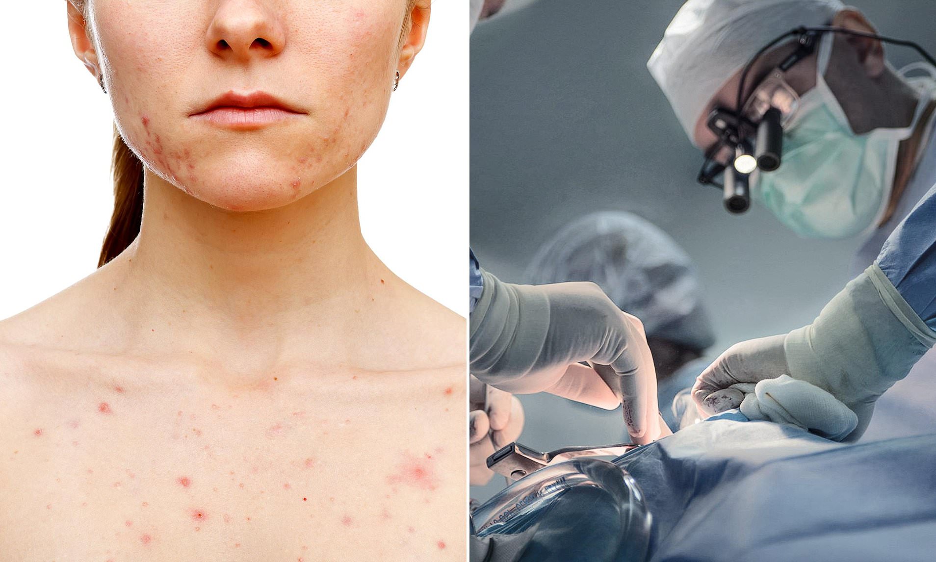 How your acne flare up could be a sign of deadly cancer, expert warns