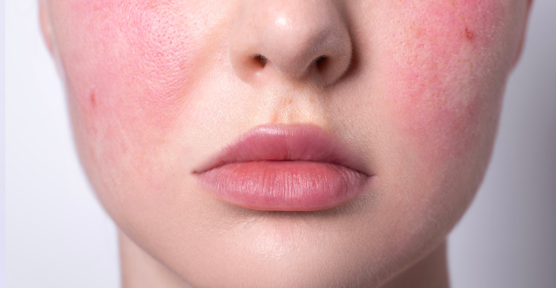 Facing up to the skin condition called rosacea