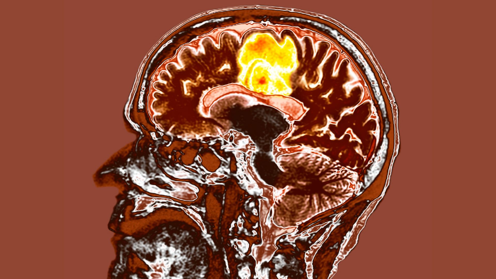 New treatment for most aggressive brain cancer may help patients live ...
