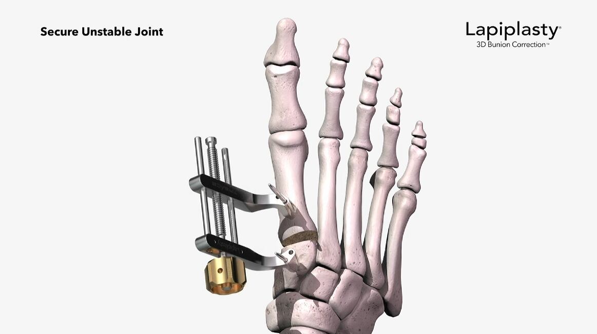 Step into comfort: Breakthrough bunion procedure